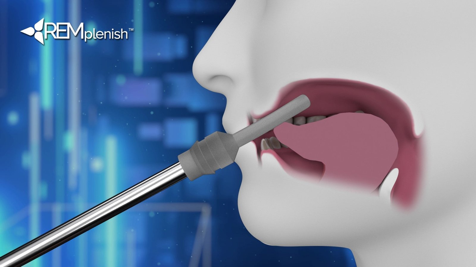 Mayo Clinic Studies REMplenish™ Myo-Nozzle's Impact on Sleep Apnea ...