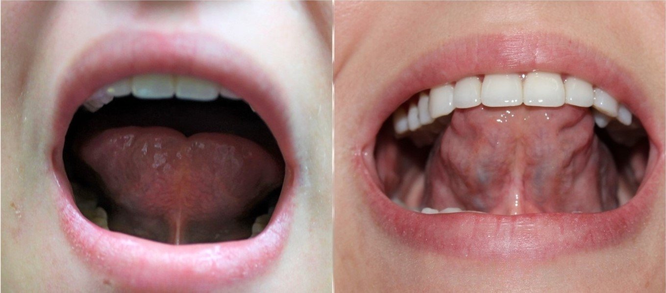 ANKYLOGLOSSIA/TONGUE ORAL RESTRICTION (TONGUE TIE) - Optimal Sleep ...