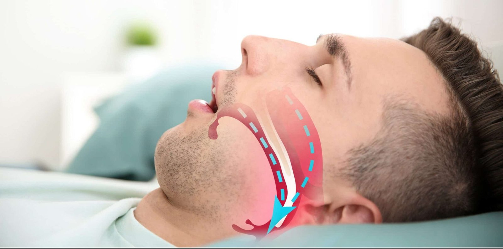 Mayo Clinic Studies REMplenish™ Myo-Nozzle's Impact on Sleep Apnea ...